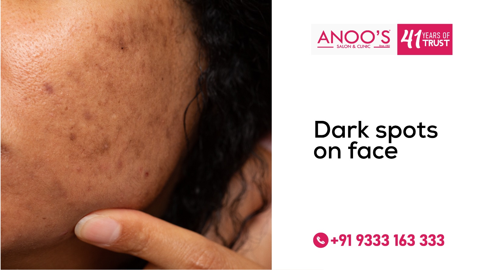 Treating Hyper pigmentation and Dark Spots on face