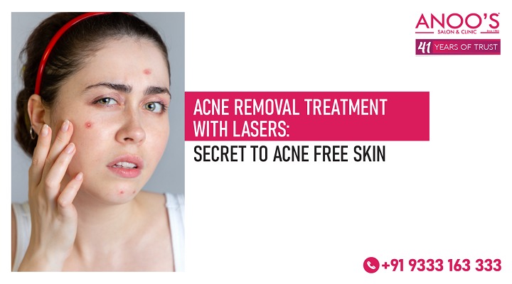 Acne Removal Treatment with Lasers - Secret to Acne Free Skin